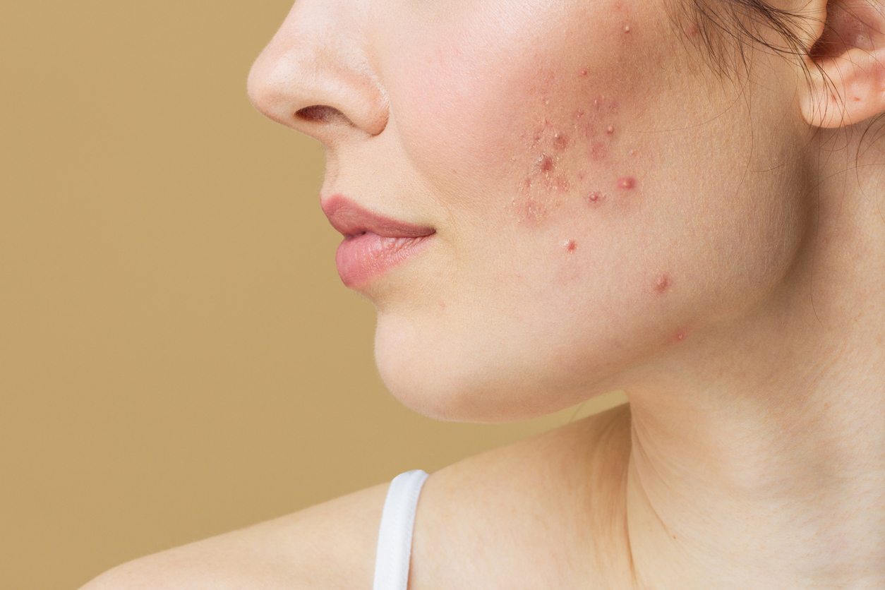 Gaan Acne Littekens Weg? - Huid met zorg